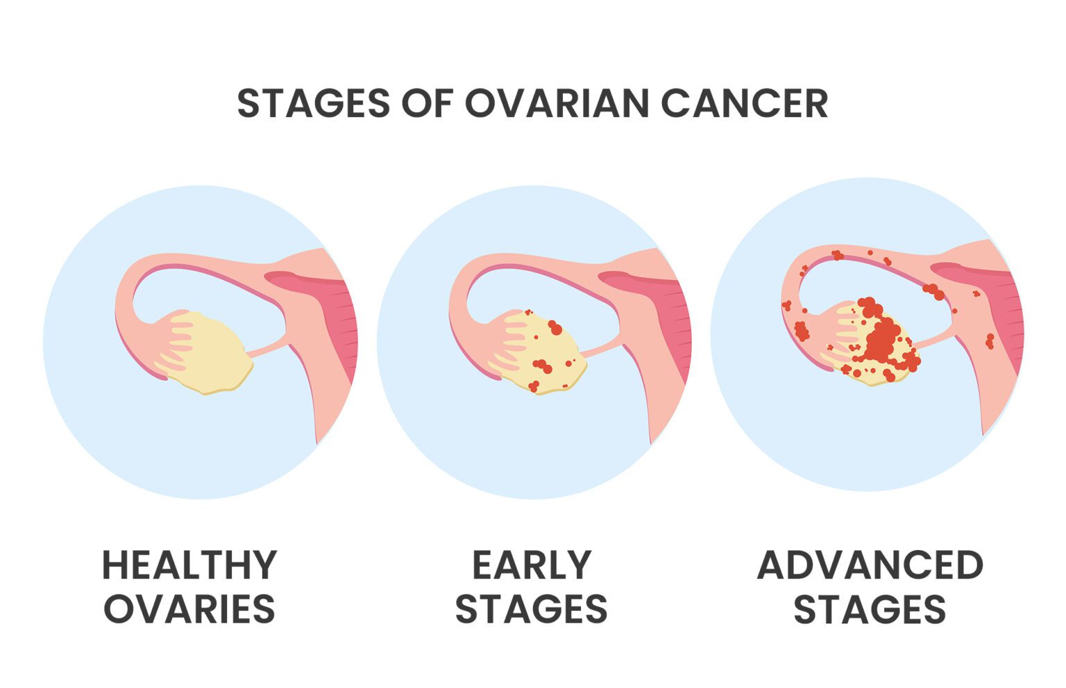 What are the different stages of ovarian cancer?
