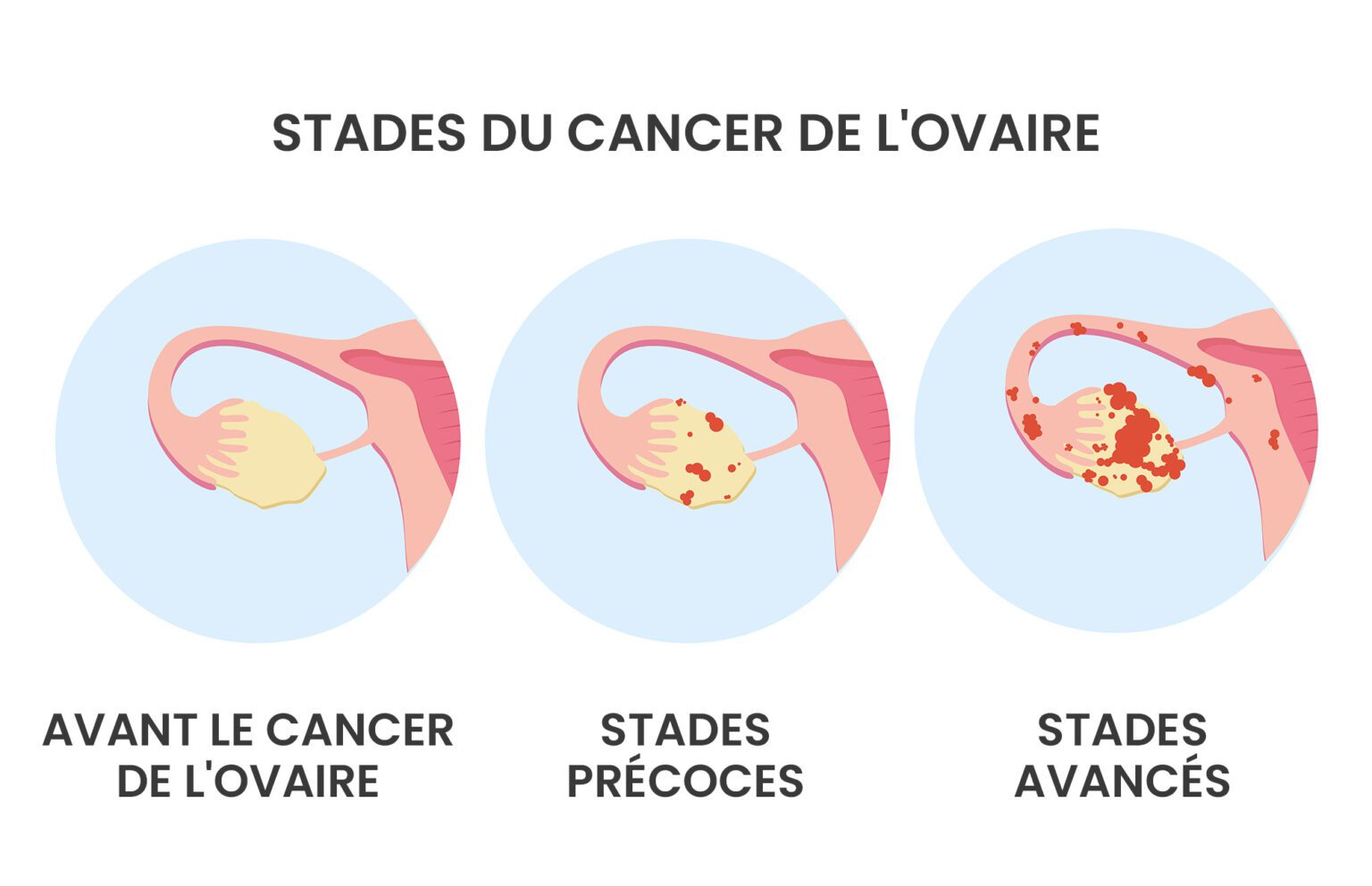 Quels sont les différents stades du cancer de l’ovaire?